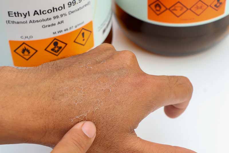 California Workers’ Compensation Cover Chemical Burn Injuries?